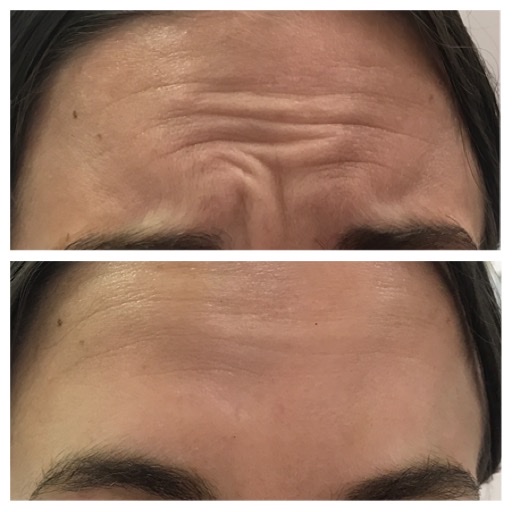 Botox Neurotox Facial Treatment - Revivify Medical Spa