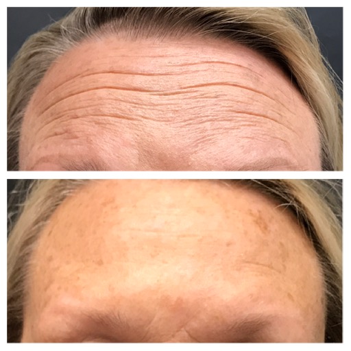 Botox Neurotox Facial Treatment - Revivify Medical Spa