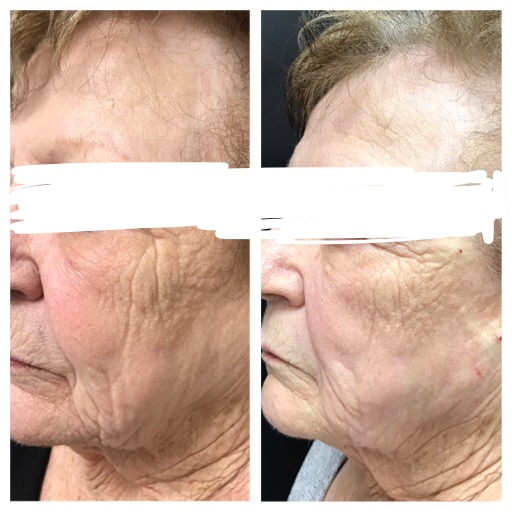 How to Get Rid of Sagging Skin and Wrinkles - Revivify Medical Spa