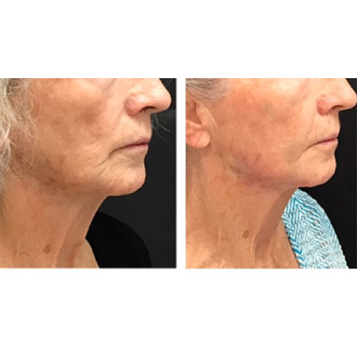PDO Threads, Non-Surgical Facelift & Neck Lift - Revivify Medical Spa